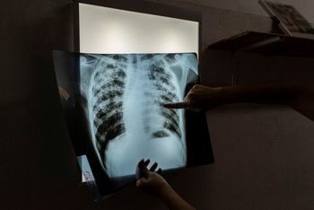 What is tuberculosis and why are deaths rising? | World Economic Forum
