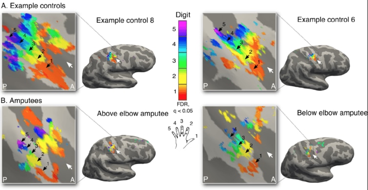 Why the brain remembers amputated limbs, even decades later | World ...